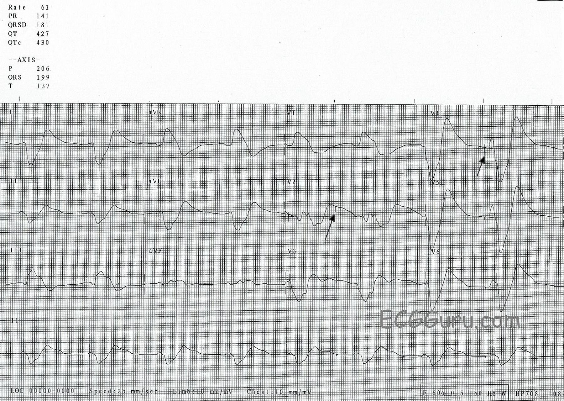 Sine wave | ECG Guru - Instructor Resources